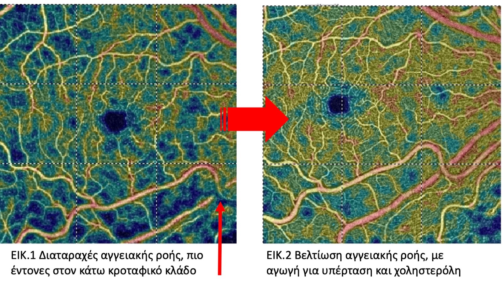 Αρτηριοσκλήρυνση/Αθηροσκλήρωση - Eye Diagnosis