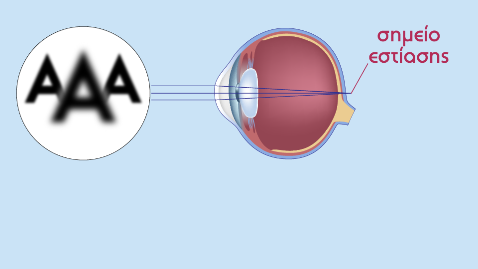 Υπερμετρωπία - Eye Diagnosis