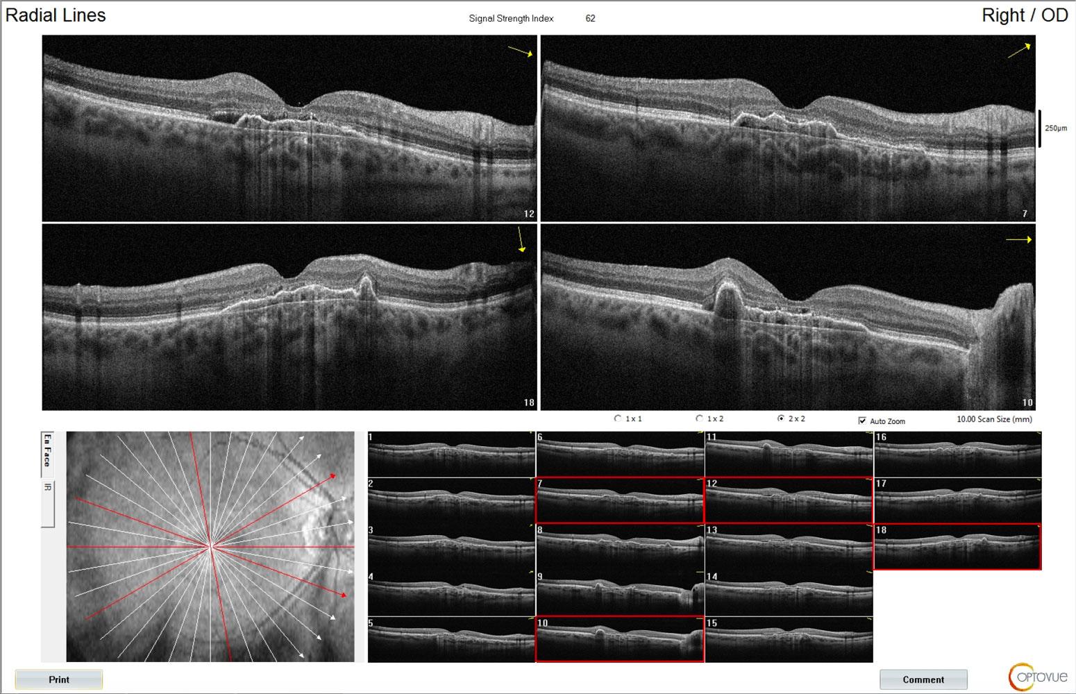 OCT - Οπτική Τομογραφία Συνοχής - Eye Diagnosis