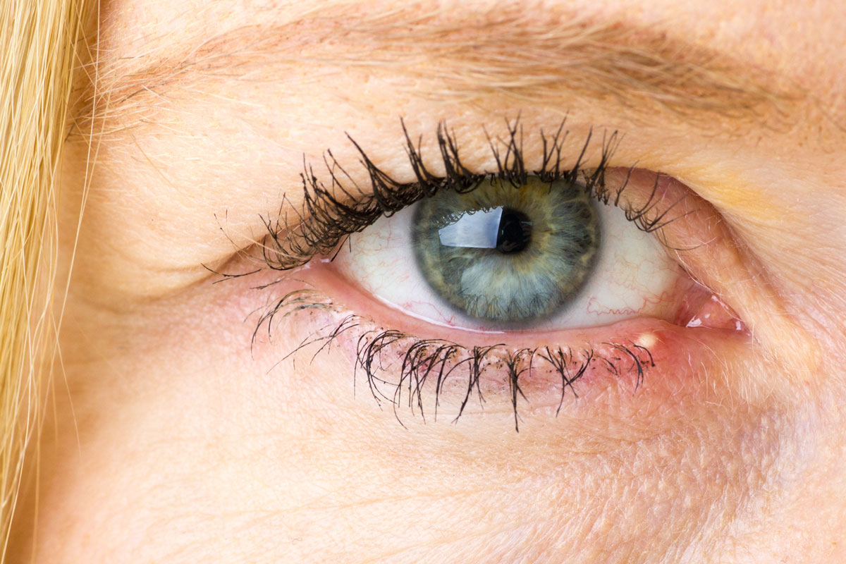Κριθή / Κριθαράκι - Eye Diagnosis