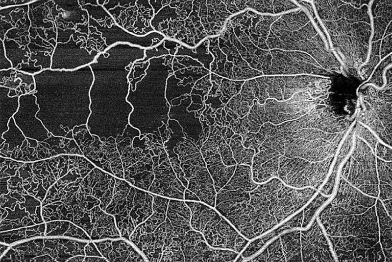 OCT - Αγγειογραφία - Eye Diagnosis