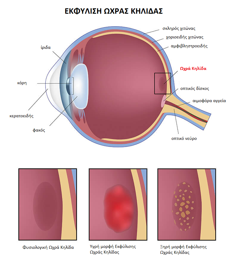Εκφύλιση ωχράς κηλίδας - Eye Diagnosis