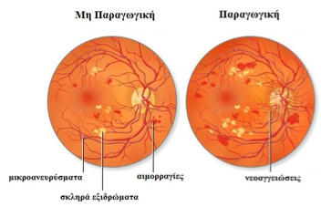 Τμήμα διαβητικής αμφιβληστροειδοπάθειας - Eye Diagnosis