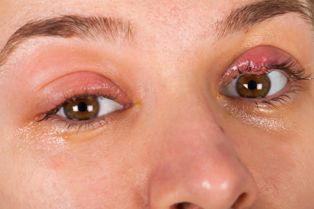 Χαλάζιο - Eye Diagnosis